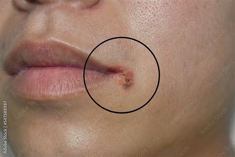 Angular Stomatitis Or Angular Cheilitis Or Perleche In Asian Young Man Common Inflammatory