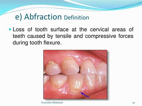 Ppt Tooth Wear Aetiology Prevention Clinical Implication