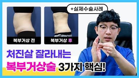 상담 전 필수 시청 복부거상술 3가지 핵심 포인트 Youtube