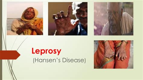 Leprosyppt Diagnosis Signs And Symptoms And Management Pptx