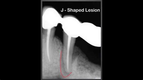 Tooth Fracturecracked Tooth Causes Diagnosis And Treatments
