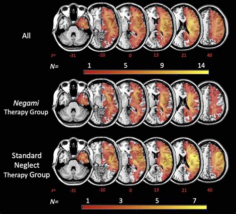 Simple Overlay Plots Overlaps Of Normalized Acute Lesions Are Shown