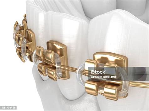 골드 중괄호 흰색 치아 개념 치과 3d 일러스트와 건강한 치아 개념에 대한 스톡 사진 및 기타 이미지 개념 노랑 도예 Istock