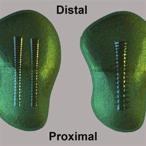A Complete Transverse Scaphoid Fracture Herbert Classification Type