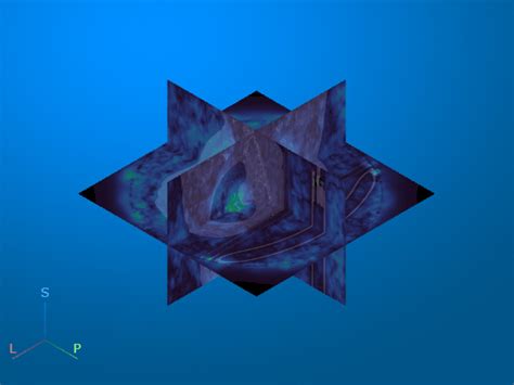 Estimate Lung Displacement Field During Breathing Using Deformable