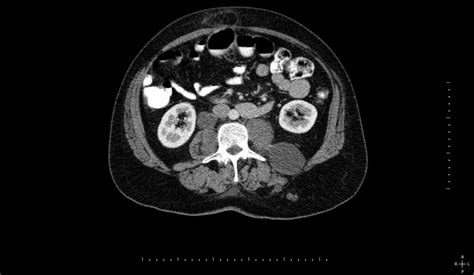 Plexiformes Neurofibrom Pacs