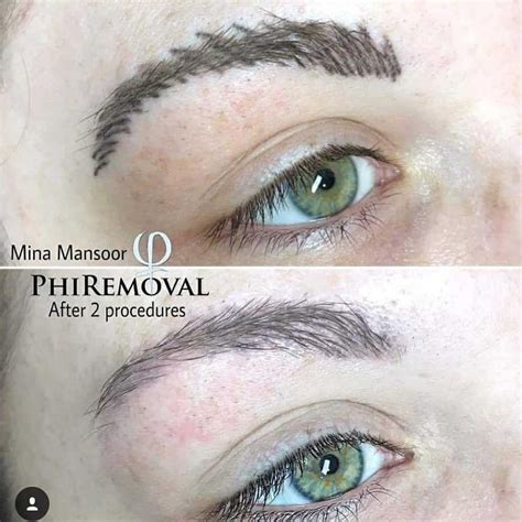 Pmu And Microblading Removal Before And After Gallery