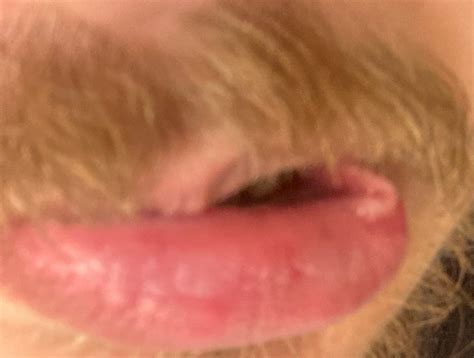 Weird Extra Fold Of Skin On Lower Lip R Medical Advice