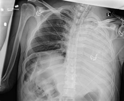 Atelectasis Atelectasis Msd Manual Professional Edition