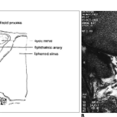 A Schematic Drawing Of Sagittal Anatomy Of The Orbital Apex Through