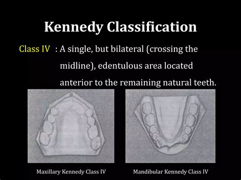 Dental Classification For Removable Partial Denture Pptx