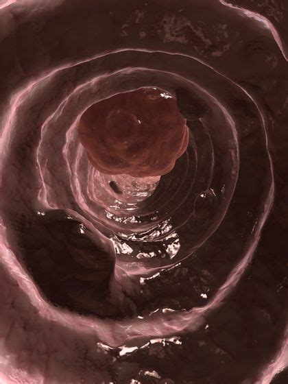 Polyps Body What Are Polyps Colorectal Polyps Cervical Polyps