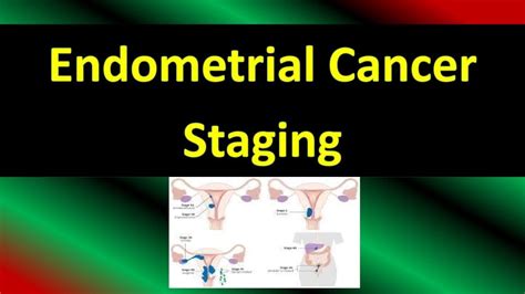 Endometrial Cancer Staging