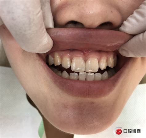 超薄瓷贴面关闭前牙缝隙 陈飞的博客 Kq88口腔博客