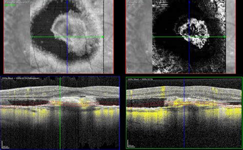 Oct Interpretation In Oct Angiography Gloucestershire Retinal Education Group Greg Oct Interpretation In Oct Angiography Gloucestershire Retinal Education Group Greg