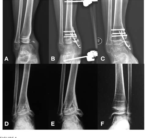 Figure 1 From Case Report Reconstruction Of Distal Medial Tibial Epiphysis Using Iliac Crest