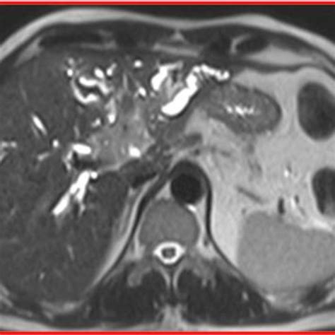 Mass Forming Cholangiocarcinoma References P Singh Radio Diagnosis