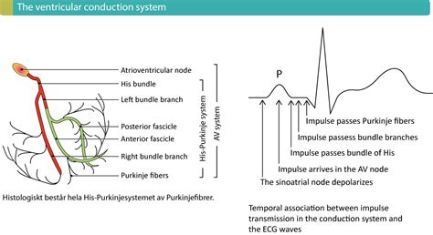 Nonspecific Intraventricular Conduction Delay Defect