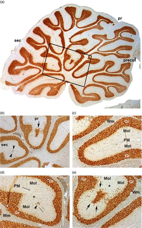 Sagittal Section Of A Cerebellum Showing Fusion And Ectopic Granular Download Scientific