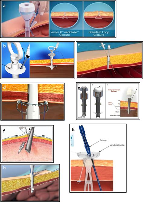 Representative Selection Of Laparoscopic Instruments And Closure Techniques Download