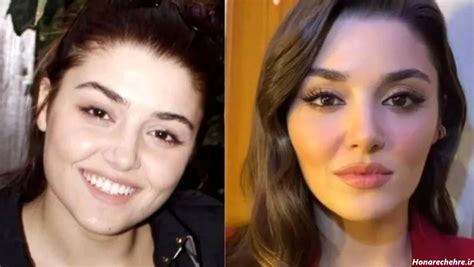 21 عکس از زیبایی هانده ارچل قبل از عمل