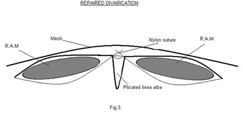 Divarication Melbourne Hernia Clinic
