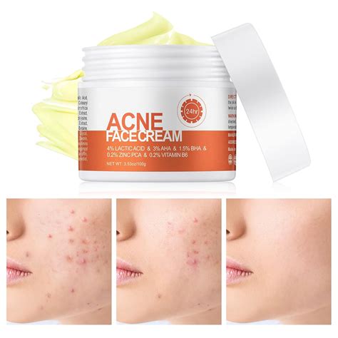 Acne Cream Salicylic Acid Cystic Acne Treatment For Face