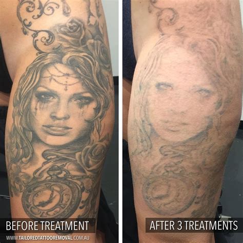 Laser Tattoo Removal Before And After Results Tattoo Removal Laser
