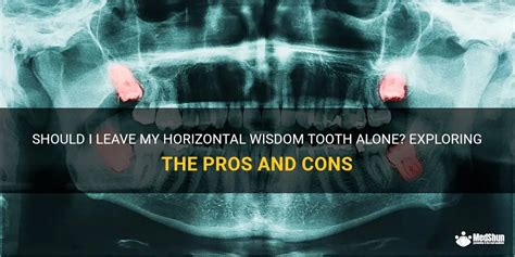 Should I Leave My Horizontal Wisdom Tooth Alone Exploring The Pros And
