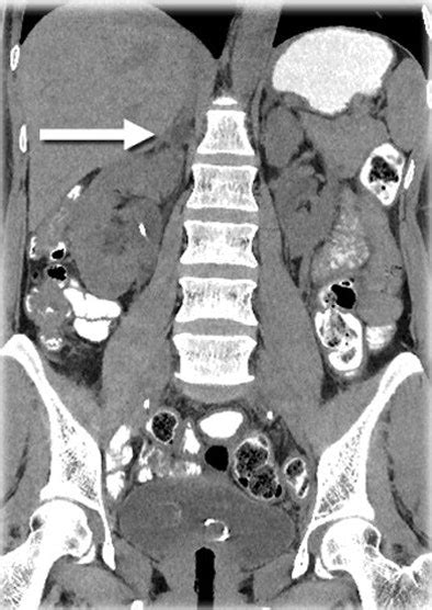Mbir Aims To Outshine Asir For Sharpness Ct Dose Reduction Auntminnie