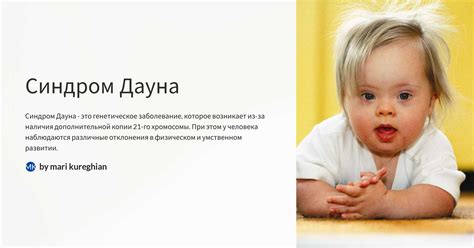 Синдром Дауна