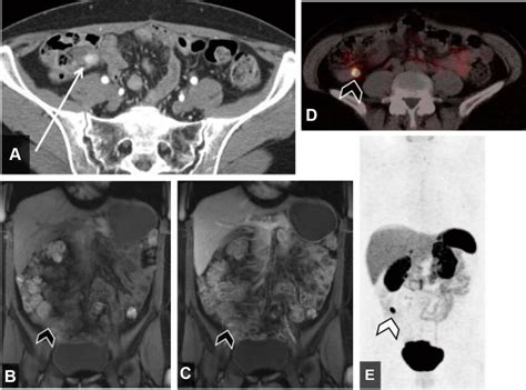 48 Year Old Female With Resected Mucinous Adenocarcinoma Of The