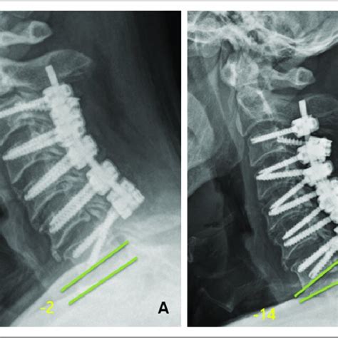Case A 74 Year Old Woman Confirmed That C7 T1 Distal Junctional Download Scientific Diagram