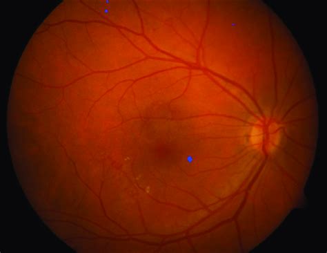 Dot Hemorrhage Segmentation From The Fundus Image Download