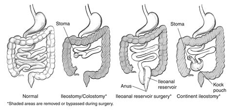 Colostomy Diagram