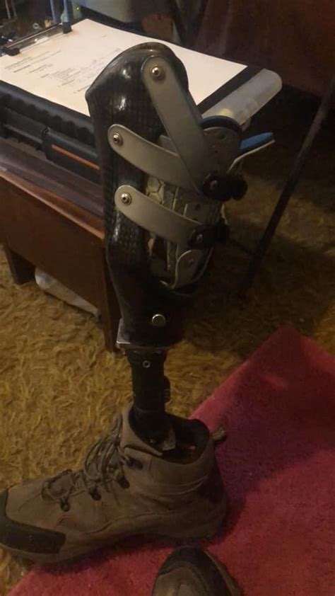 Martin Bionics Our Below Knee Hybrid Socket Less Socket™