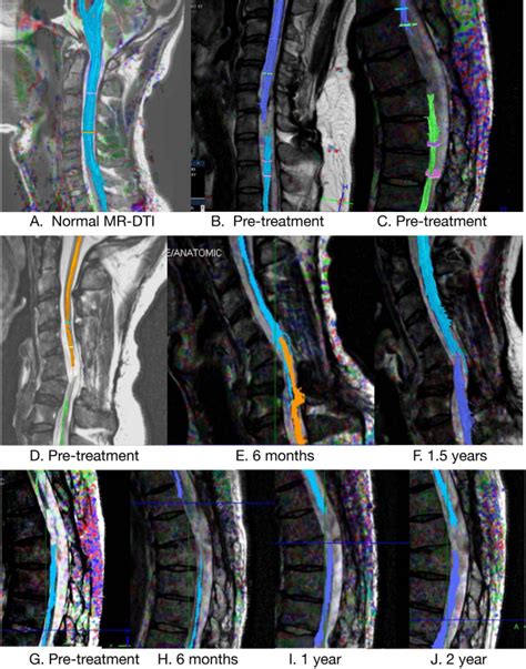 Magnetic Resonance Diffusion Tensor Images Mr Dti Of A Normal Download Scientific Diagram