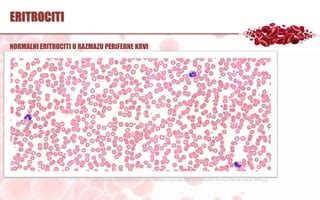 Hereditarna Sferocitoza PPTX