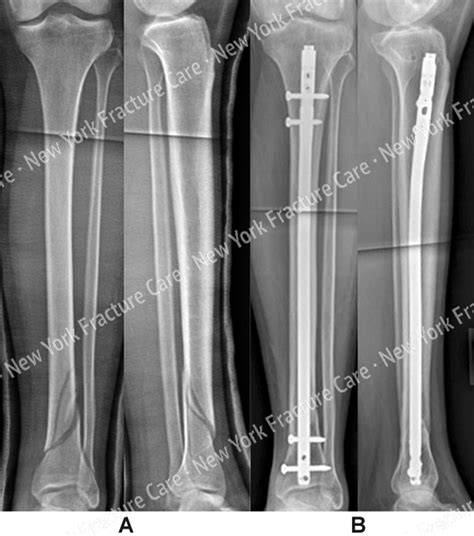 Tibia Fractures Lower Extremity New York Fracture Care