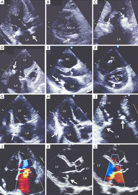 Four Different Examples Of Patients With Mitral Annular Calcification Download Scientific
