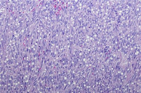 Malignant Transformation Process In Gastrointestinal Stromal Tumors
