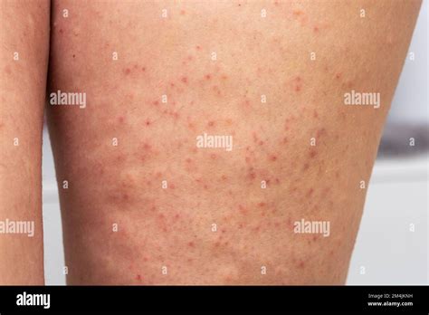 Close Up Of Womans Legs With Keratosis Pilarar An Acute Folliculitis Causing Pinpoint Redness