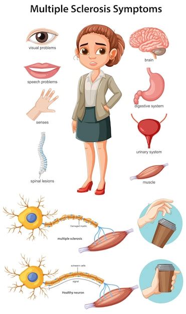 Ilustración Vectorial De Los Síntomas Y Efectos De La Esclerosis