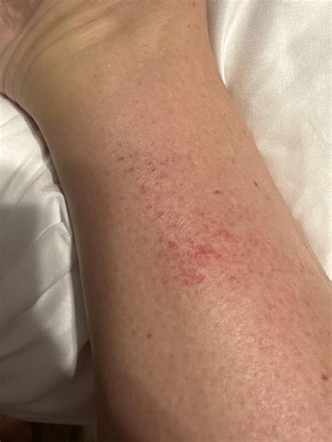 Red Rash On Ankle Reczema