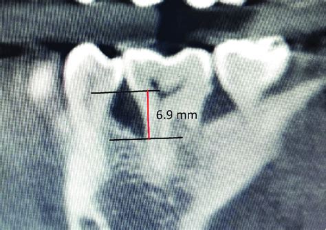 Sagittal Section Preoperative Image Of Angular Defect Measured From Download Scientific