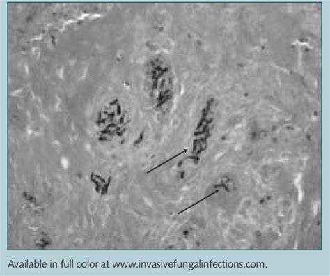 Melanin Stain Masson Fontana On A Brain Biopsy Shows Moniliform Download Scientific Diagram