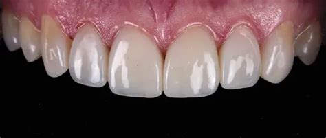 Direct Composite Veneers A Guide To Layering And Preparation