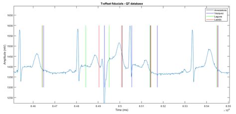 Ecg Extract From Qt Database Showing The T Offset Detection Points From