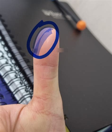 엄지손가락 감각 이상 지식in