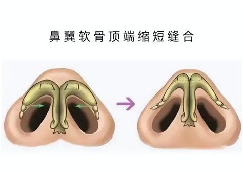鼻子肉多、鼻翼宽、鼻头大，怎么通过手术改善 知乎
